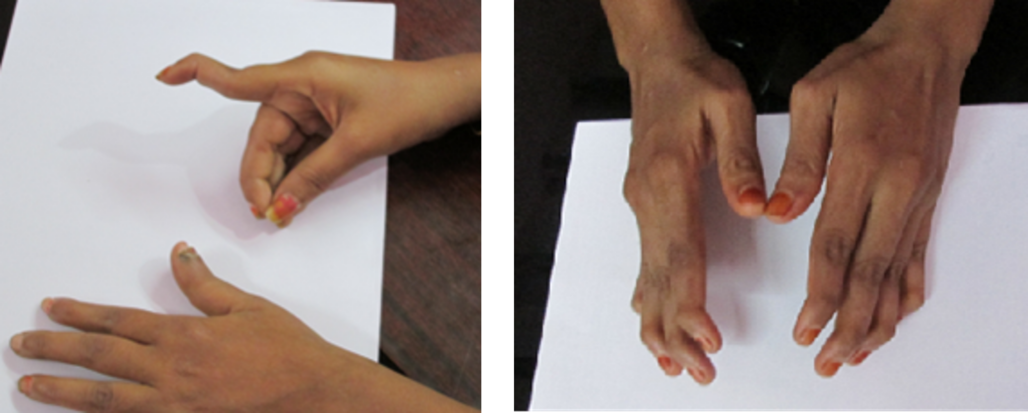 Swan neck deformity - Medi Edu Tv